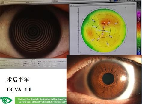 翼状胬肉手术详解（内附29张经典手术ppt） 中国眼科网