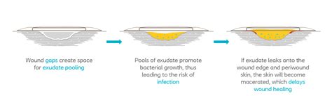 Learn How To Asses ‘the Gap In Wound Care