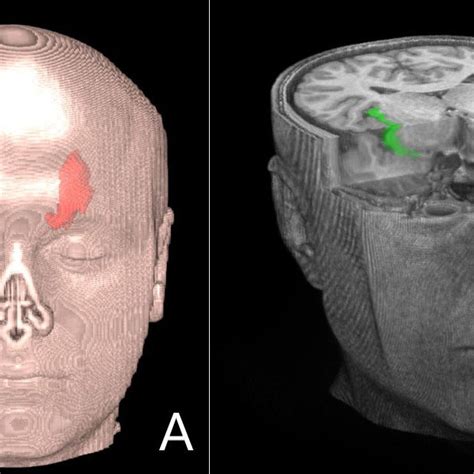 Insular Cortex Displayed On A T1 Image A Coronal Section Showing The