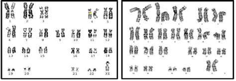 Karyotype Of Monosomy X 45x And 46xx Full Size Doi
