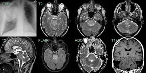 Pembrolizumab Associated Brainstem Encephalitis Neuroradiology