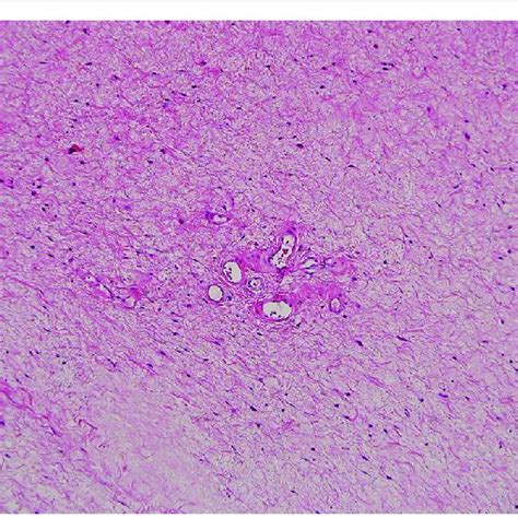 Pdf Giant Fibroepithelial Stromal Polyp Of The Vulva Largest Case
