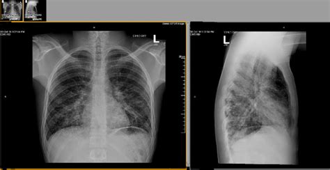 Cxr Pa And Lateral View On Initial Presentation Showing Coarse