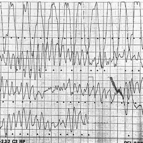 Sustained Monomorphic Vt Induced By Programmed Electrical Stimulation Download Scientific Diagram