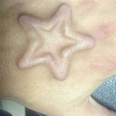 What Is Subdermal Implant Body Art Guru