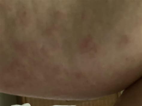 Urtica Or Contact Dermititis R Urticaria