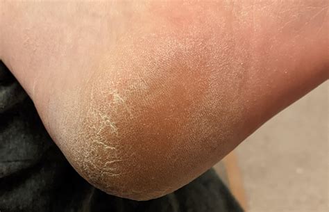 Skin Concerns Is This Dry Skin Seb Derm Or Athletes Foot R