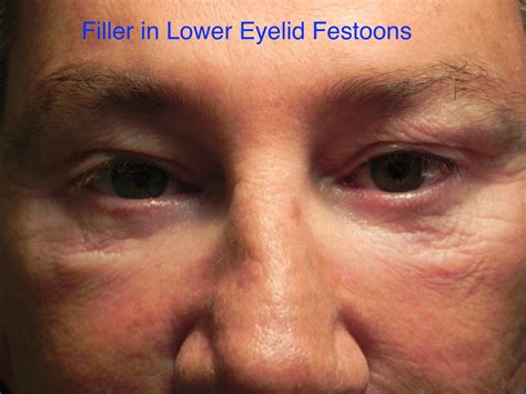 10 Things You Need To Know About Festoons Adam Scheiner Md Dr Adam