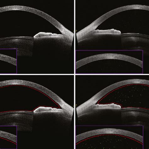 3 Standardized Sun A Grading System For Ac Cell And Flare Severity