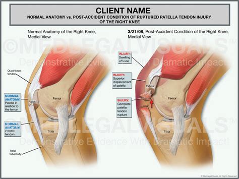How To Heal From A Ruptured Patellar Tendon Injury