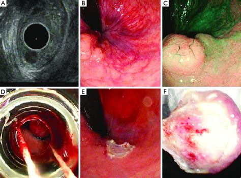 Endoscopic Findings A Eus Image Showing A Hypoechoic Nodule Arising Download Scientific