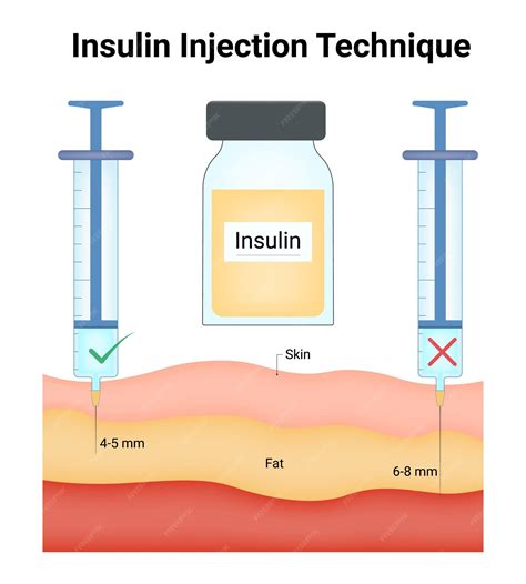 Premium Vector Insuline Injection Technique Vector Illustration