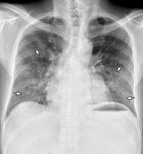 Pneumonia X Ray Pattern