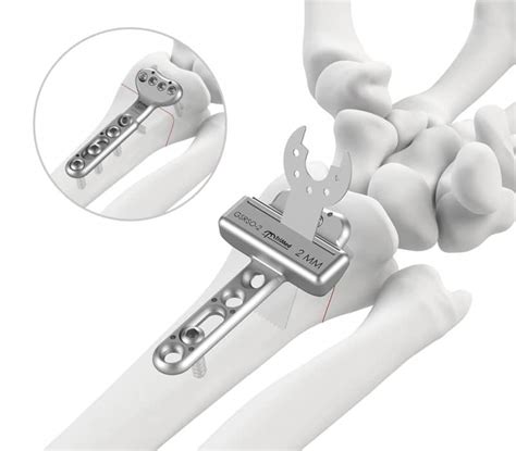 Radial Osteotomy Plate Trimed Inc