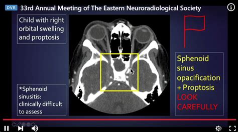 Sphenoid Sinus And Cavernous Sinus