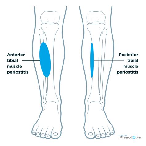 Shin Splints In Runners Common Causes And Prevention Tips Physioextra