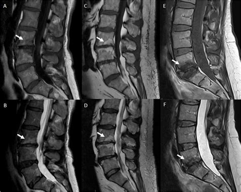 Modic Alterations Sagittal T1 Weighted And T2 Weighted Mr Images