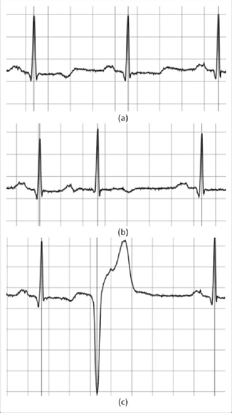 Irregular Heart Beat Graph Heart Palpitations Should I Be Worried If