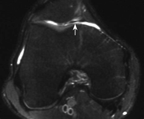 Anatomy And Mr Imaging Appearances Of Synovial Plicae Of The Knee