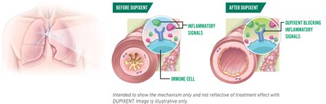 How Dupixent® Dupilumab Works In Copd