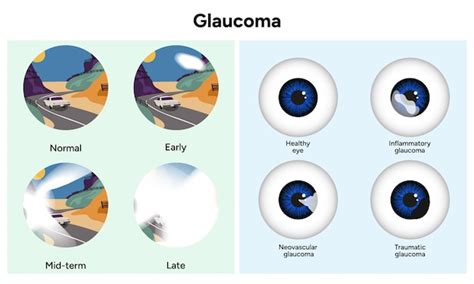 Premium Vector Inflammatory Glaucoma Neovascular Glaucoma Traumatic