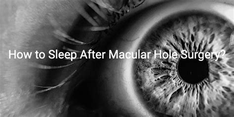 How To Sleep After Macular Hole Surgery Eye Bulletin