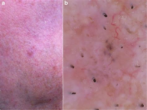 A Clinically A Non Pigmented Bcc However Dermoscopy B Revealed The