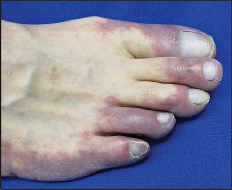 Primary Antiphospholipid Antibody Syndrome Download Scientific Diagram