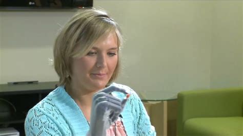 Flesh Eating Bacteria Amputee Aimee Copeland Uses New Bionic Hands Cnn