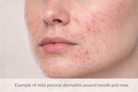 Understanding Perioral Dermatitis Causes And Treatment Guide We Solve Skin