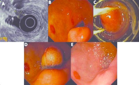 Case 10 A Net In The Duodenum Bulb B Eus Image Nodular Lesion Download Scientific Diagram