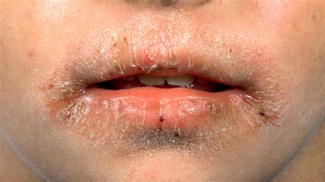 Eczematous Cheilitis Lips