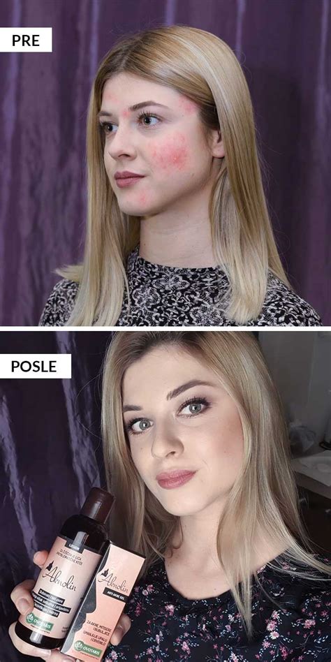 Pobedite Pubertetske Bubuljice Uz Ovaj Vodič Ovotaris