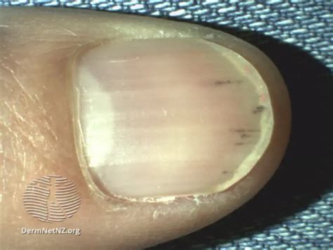 What Causes Horizontal Ridges In Fingernails