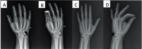 A Ap B Lateral And C Oblique Radiographs Of The Second Arrival At