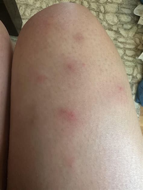 Folliculitis On Legs Rfolliculitis