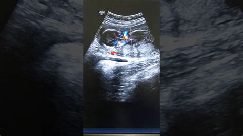 Ultrasound Video Showing Single Round Of Nuchal Cord Cord Around Neck