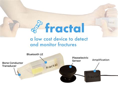 Fractal Acoustic Detection And Monitoring Of Bone Fractures Big