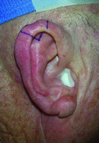 21 Ear Reconstruction Pocket Dentistry