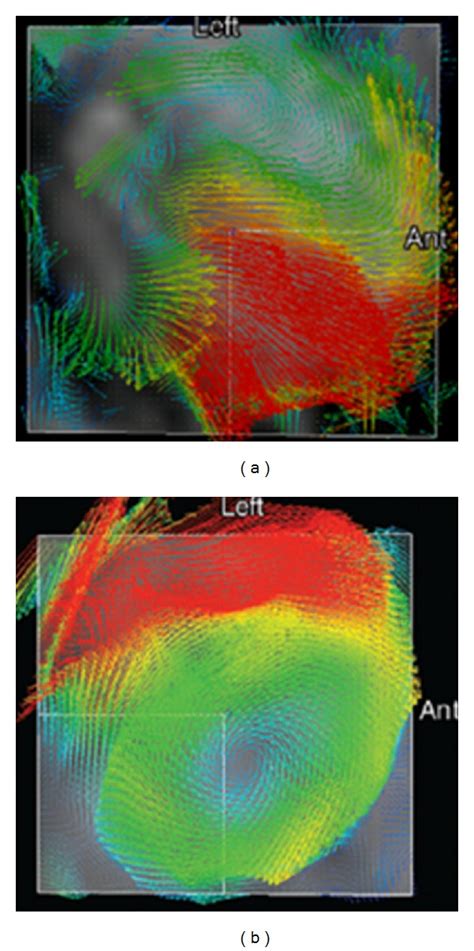 Unique Transvalvular Flow Patterns In Bav Patients With Right Left Cusp