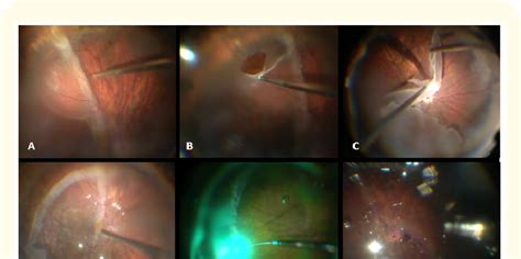 A Subretinal Injection Of Bss Under Retinal Fold B C Retinectomy And