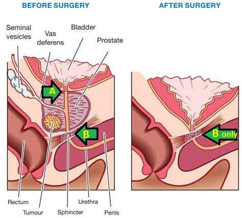 Radical Prostatectomy Procedure