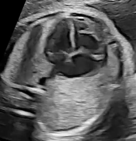 Dr Ladbans Kaur On Linkedin Fetalecho Fetal Echo Lv Rv Dysfunction Systolic Tei Index…