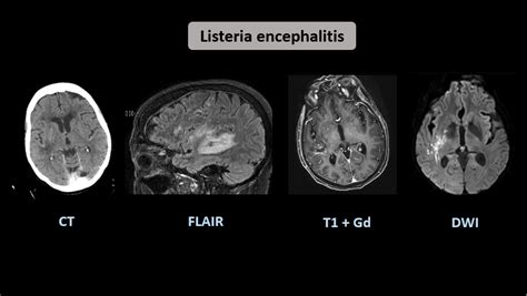 Encephalitis Mri