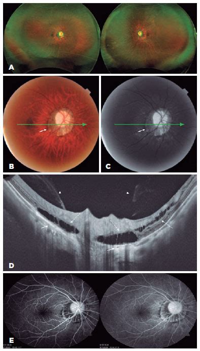 Peripapillary Staphyloma