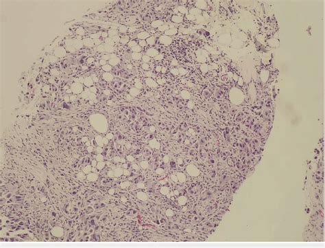 Patient 1 Tru Cut Biopsy Of The Supraclavicular Lymph Node Tumor