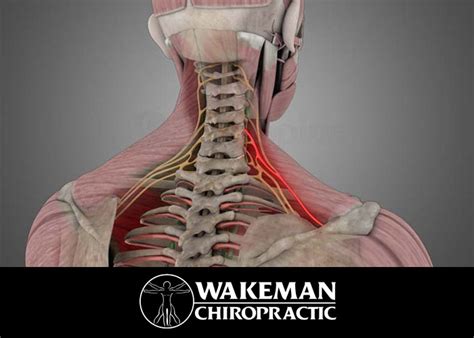 Wakeman Chiropractic Cervical Radiculopathy Refers To A Pinched Nerve In Your Neck That Causes