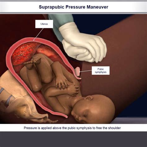 Medical Legal Exhibits Legal Animations And Trial Graphics Tria