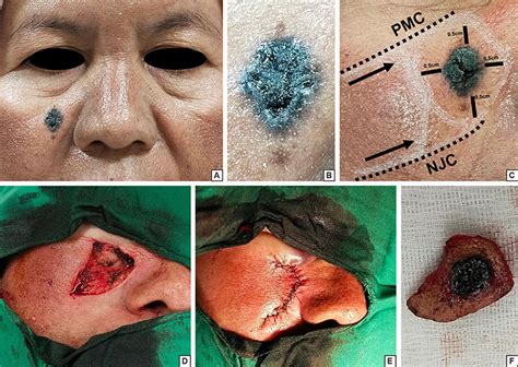 A Successful Defect Closure After Excision Of Nodular Basal Cell Carci