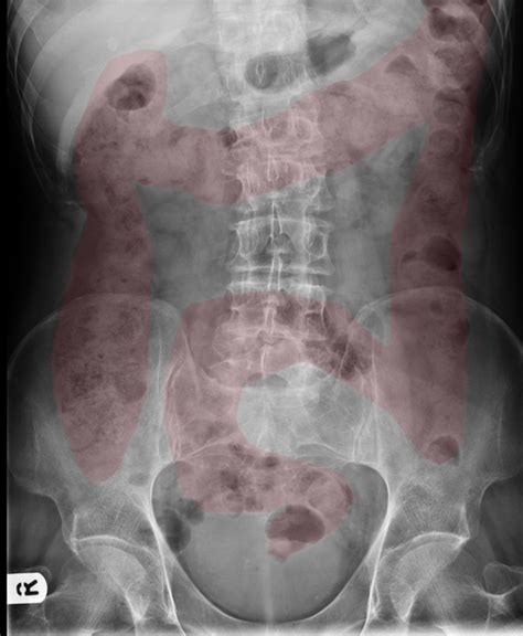 Normal Abdominal X Ray Gasless Abdomen In The Adult What Does It